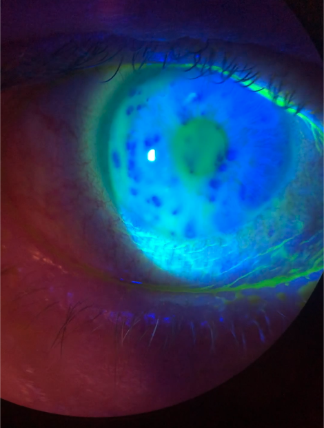 Dry Eye Patient (B) | Optometry Times - Clinical News & Expert ...