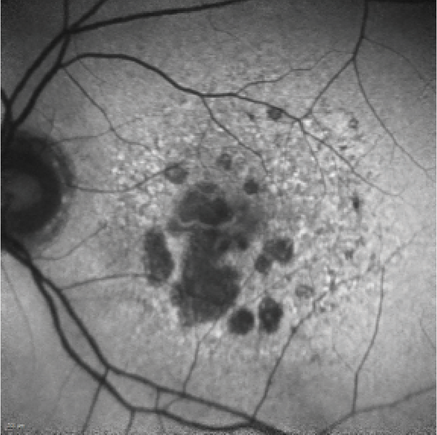 A deeper look at pegcetacoplan | Optometry Times - Clinical News ...