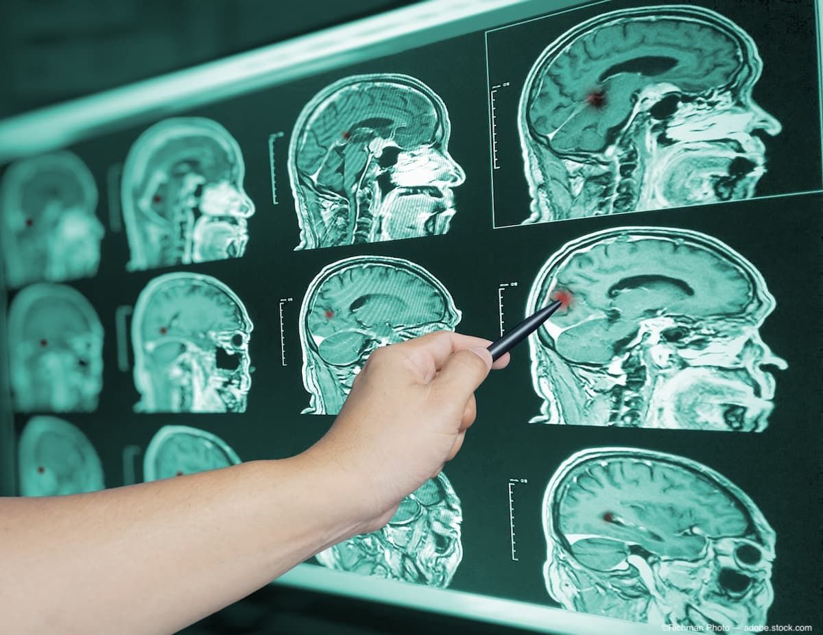 Diplopia in concussion – what is normal? What is abnormal, and when ...