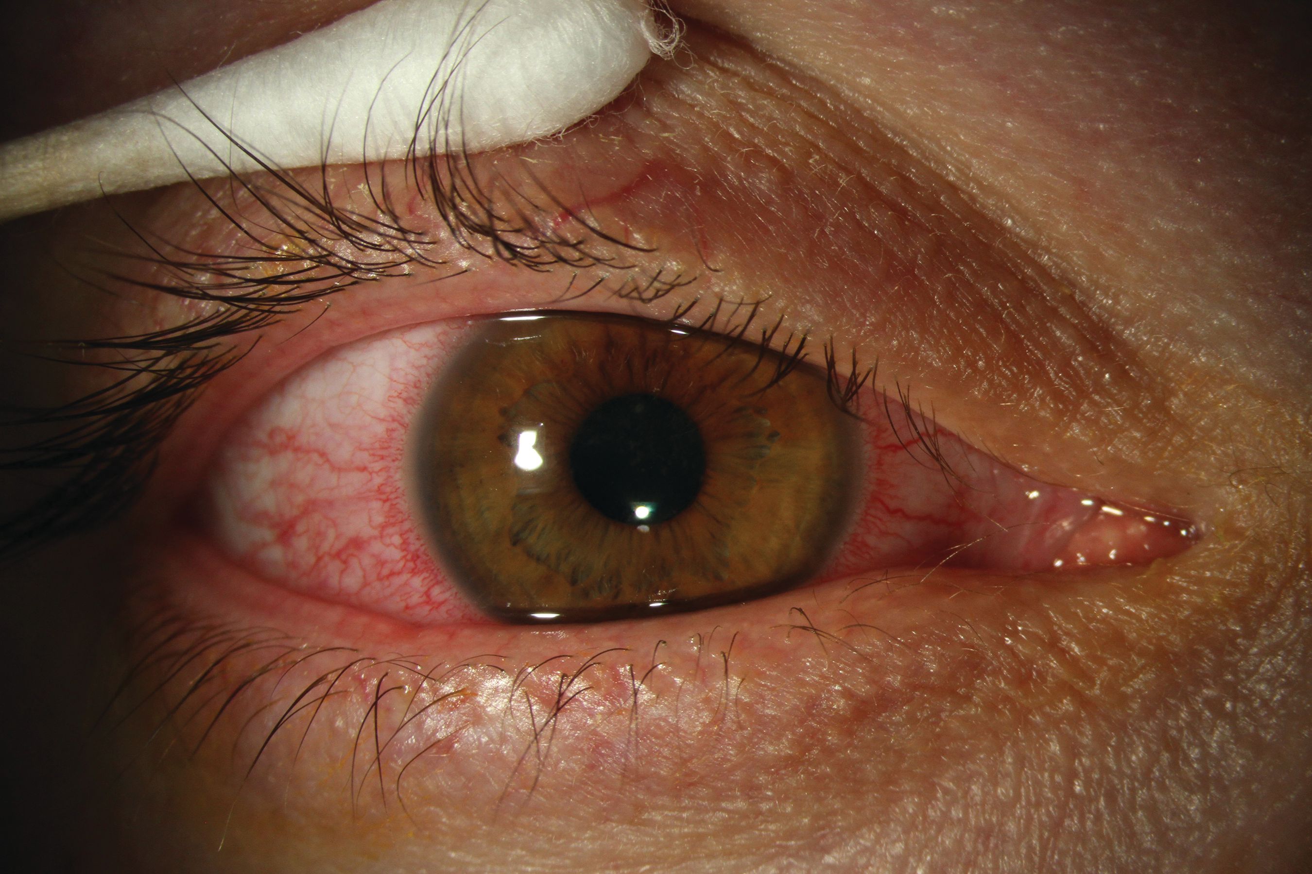 Preparation is key to fighting dry eye while traveling | Optometry ...