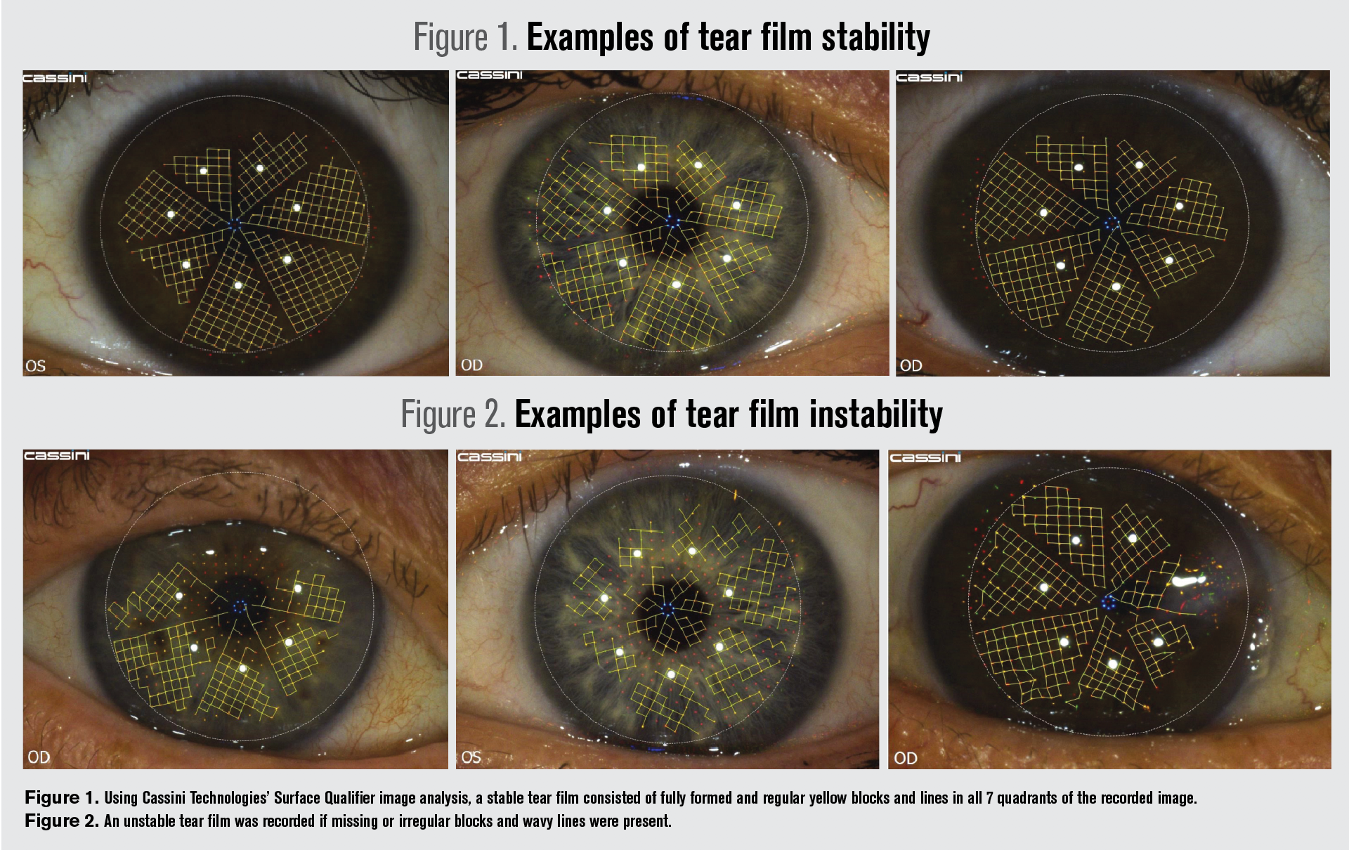 How the tear film affects IOL measurements | Optometry Times - Clinical ...