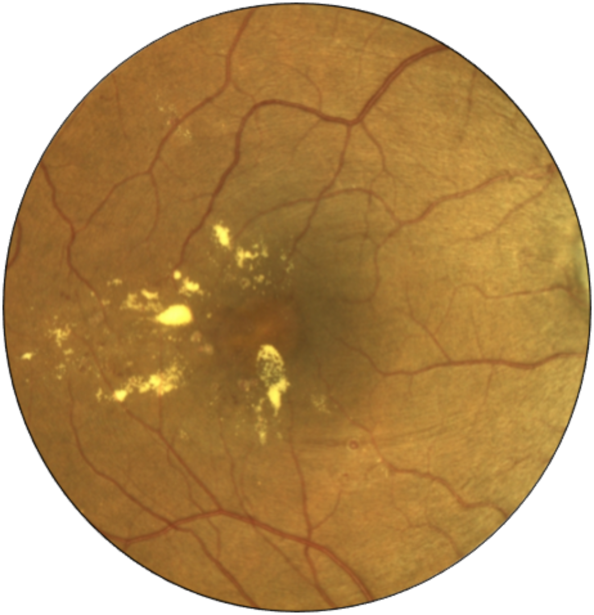 Diabetic retinopathy clinical pearl pictorial | Optometry Times
