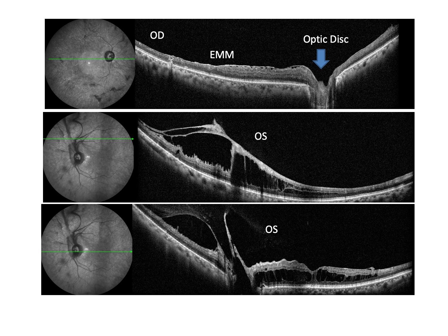 Know the many facets of diabetic retinopathy