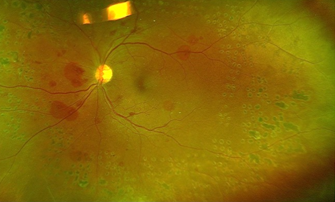 Role of comorbidities in management of diabetic retinopathy | Optometry ...
