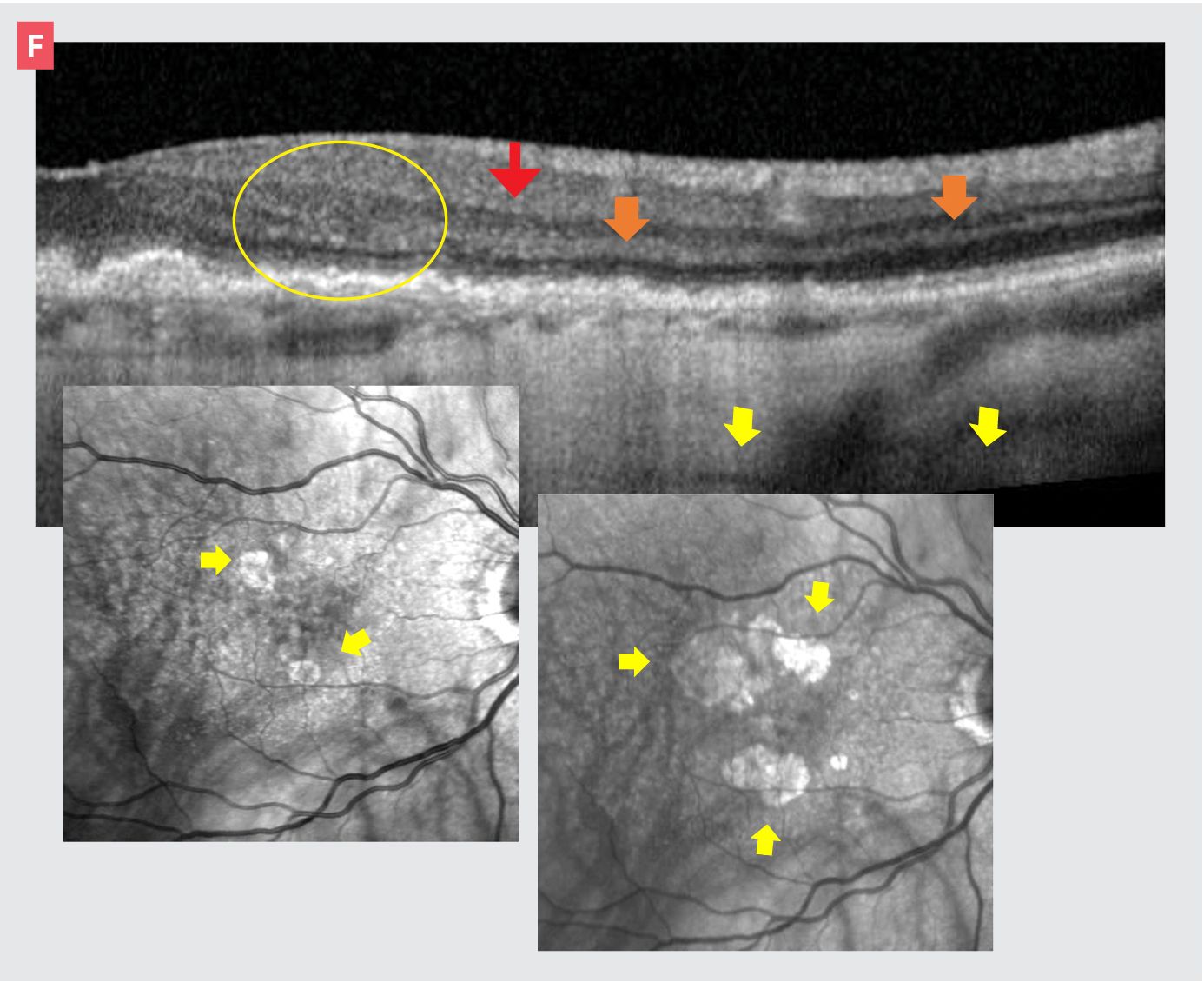 Geographic atrophy: What to know and why