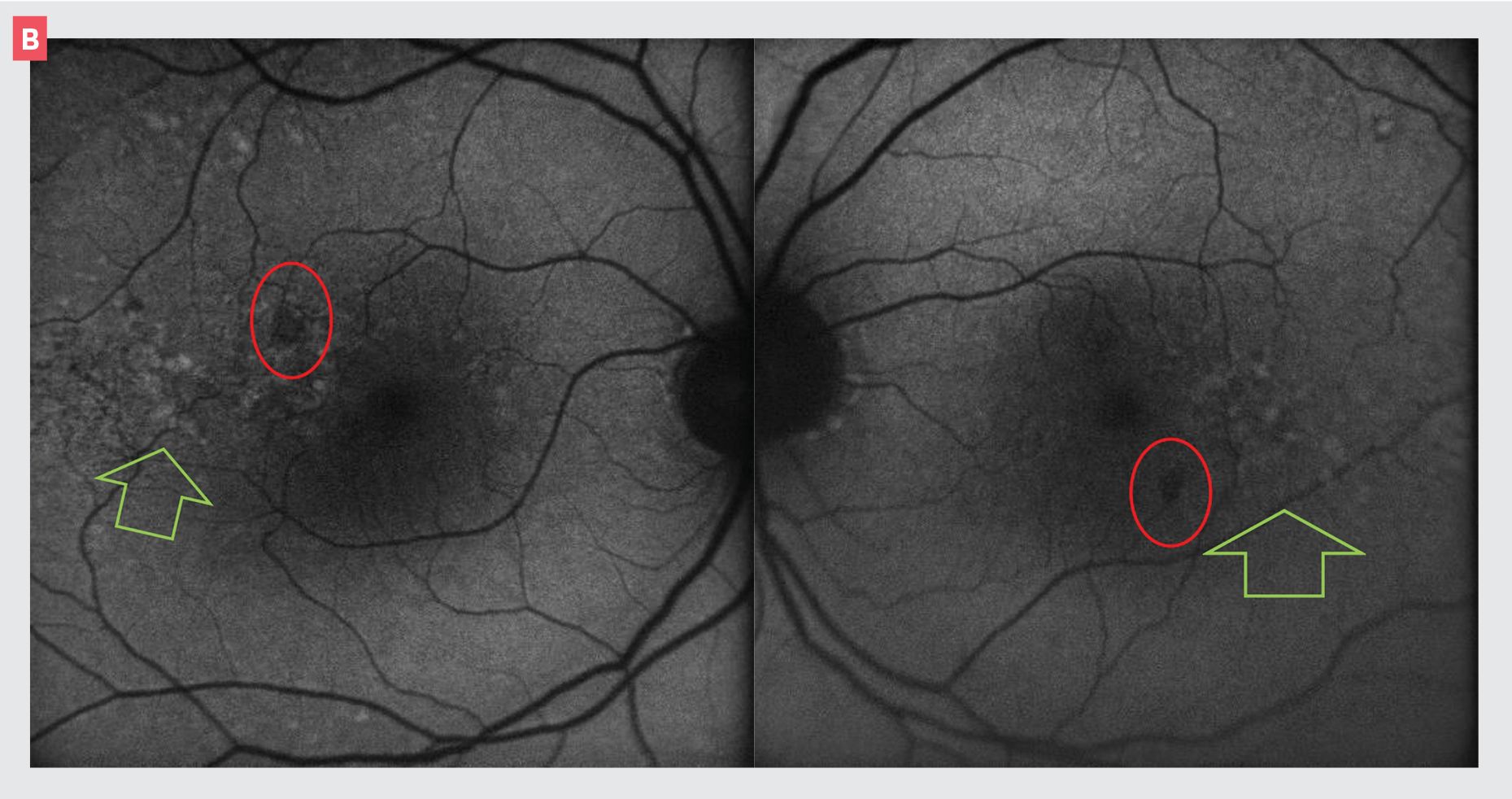 Geographic atrophy: What to know and why