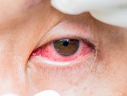 Eysuvis FDA approved for dry eye treatment