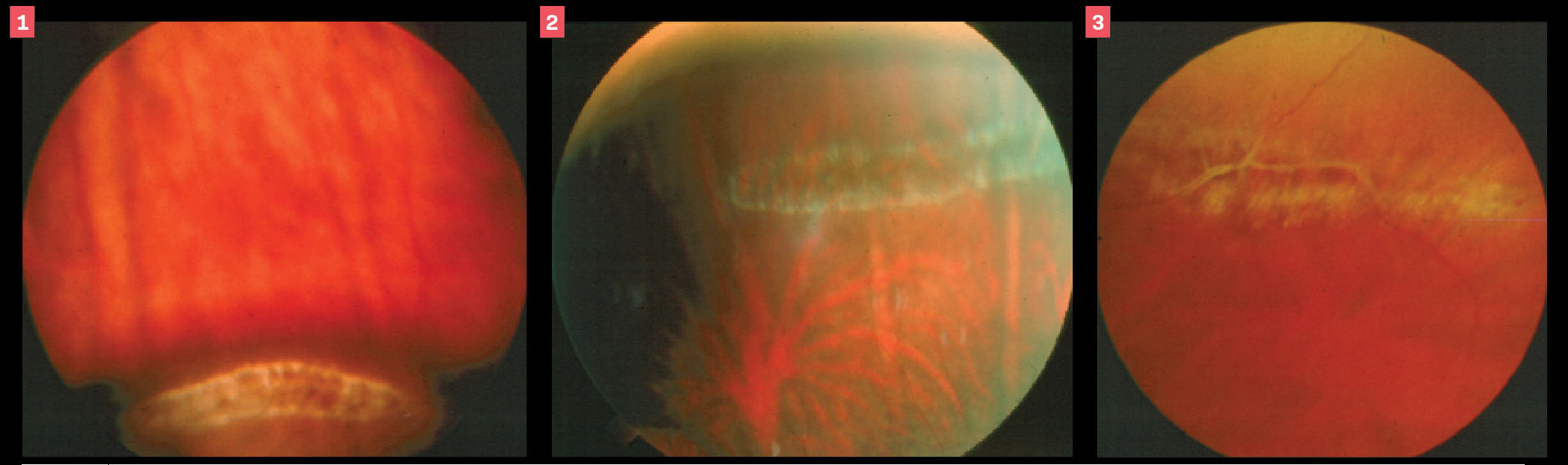 Into the periphery with lattice retinal degeneration | Optometry Times ...