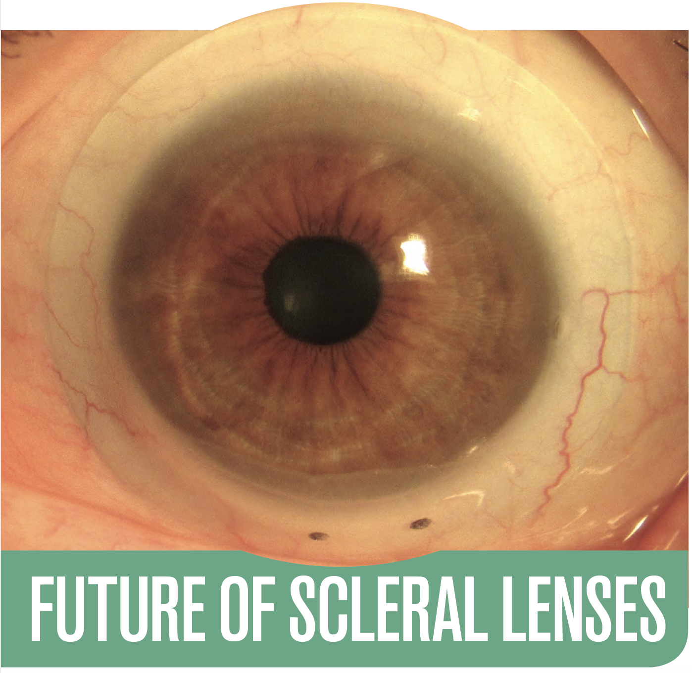 Corneo-scleral topography allows for precise fitting | Optometry Times ...