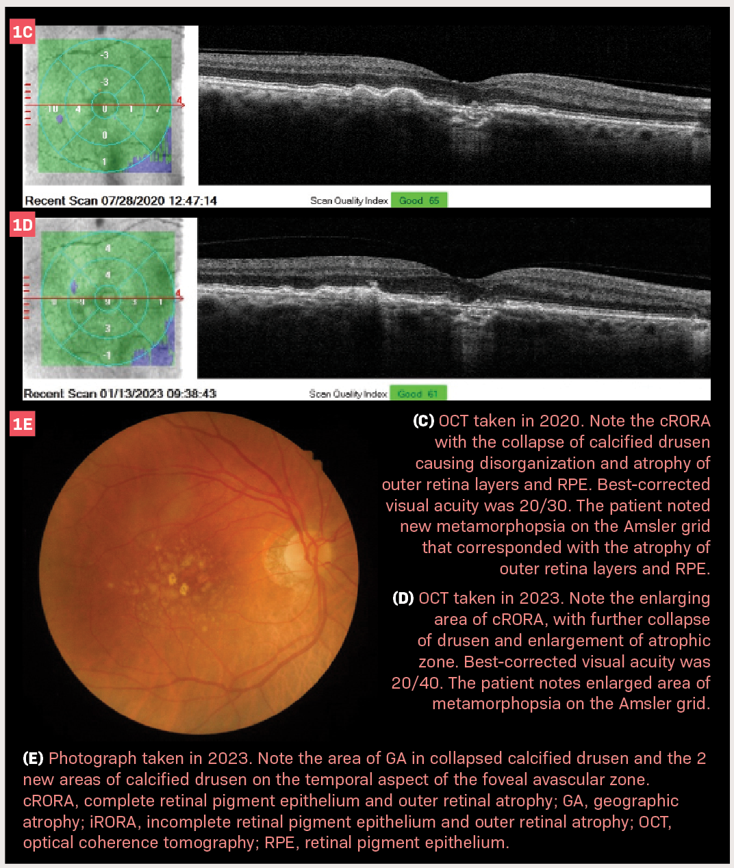 Keeping An Eye On Geographic Atrophy