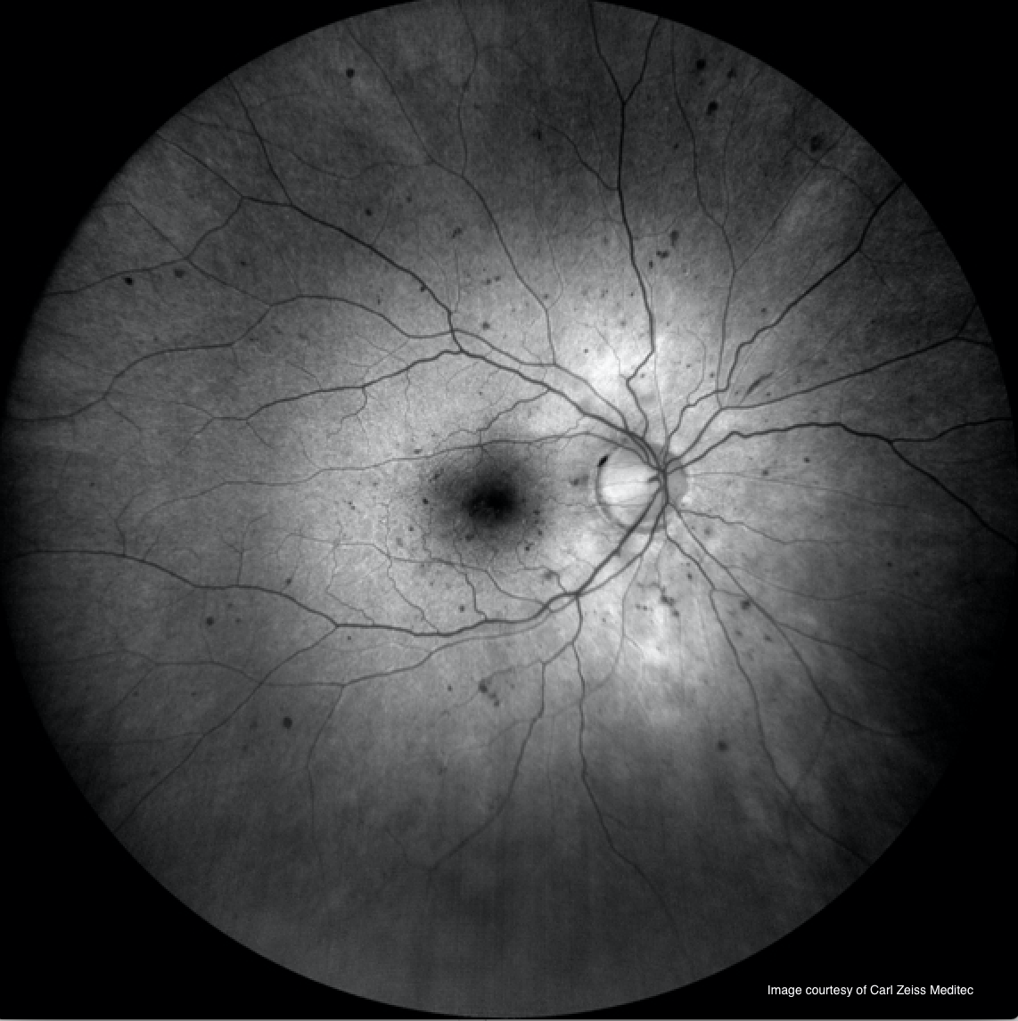 When to refer patients with diabetic retinopathy | Optometry Times ...