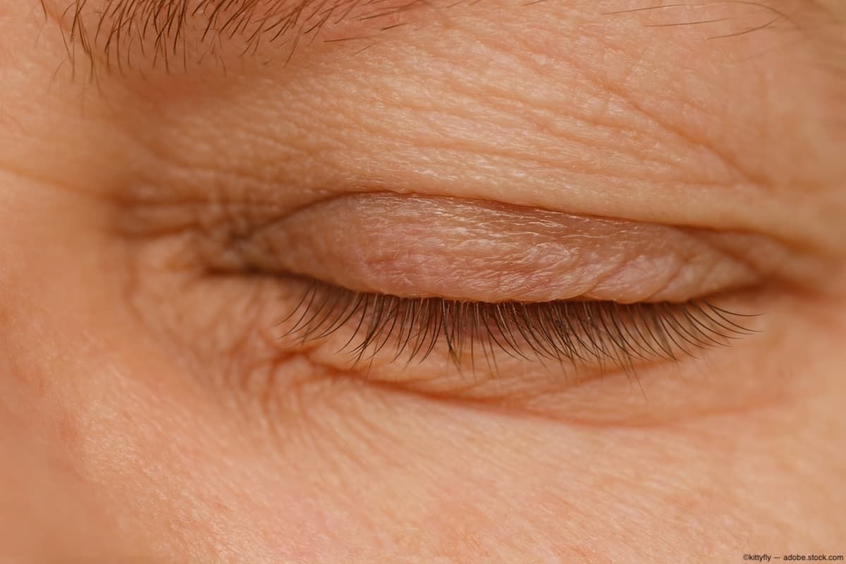 Study underscores importance of upper eyelid meibography in early ...