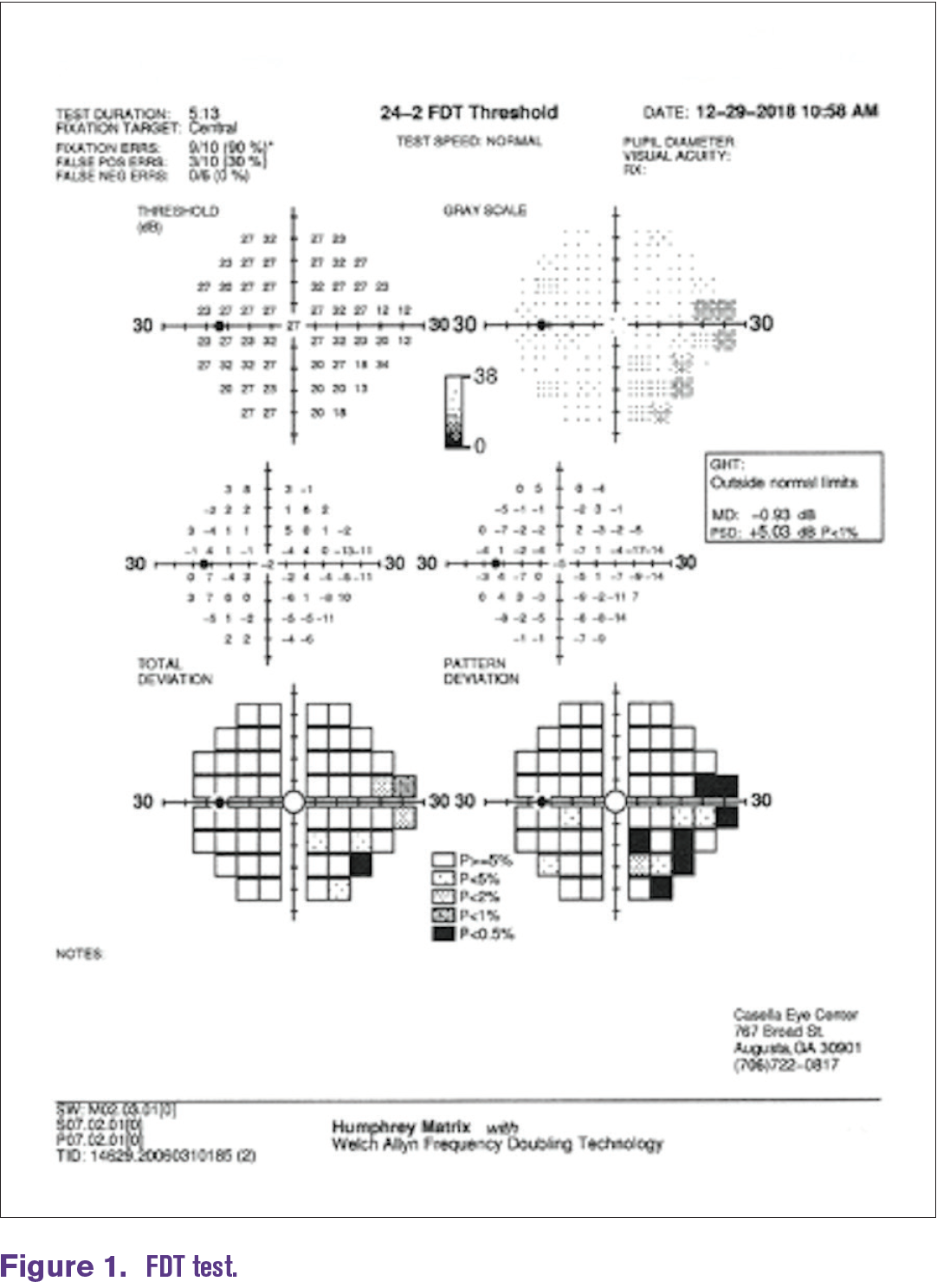 Study finds FDT visual field studies are effective glaucoma detectors
