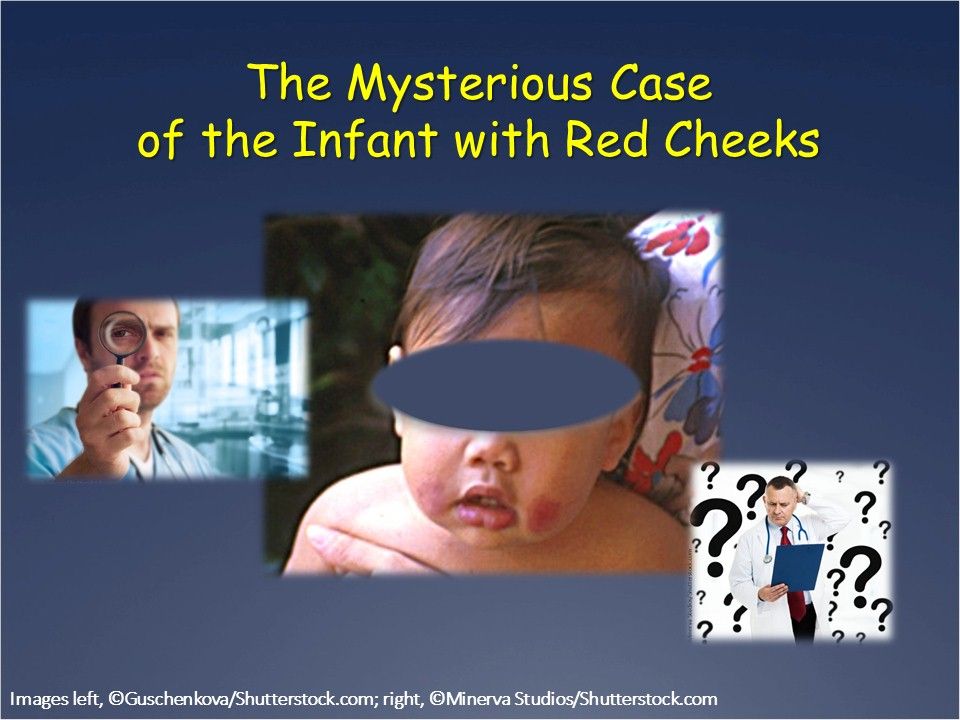 The Mysterious Case of the Infant with Red Cheeks