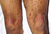 Bullous Pemphigoid: An Autoimmune Blistering Disorder