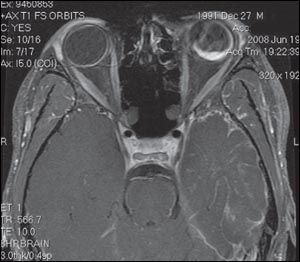 Progressive Unilateral Vision Loss | Patient Care Online