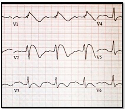 Recurrent Syncope in a 32-year-old Woman: Anxiety?