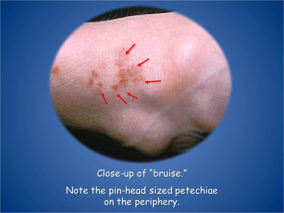 Puzzling Purpuras: Tale of an Unusual Bruise | Patient Care Online
