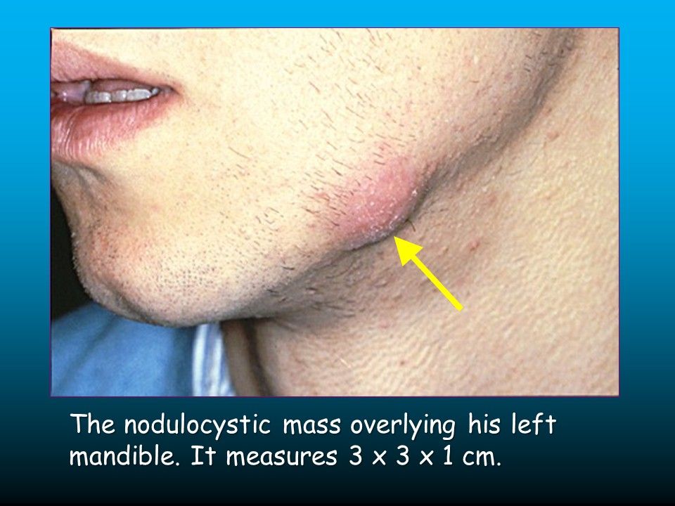 Lumpy Jaw In A 20 Year Old Male Resists Treatment