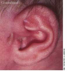 Accessory Tragus on Left Ear of an Infant