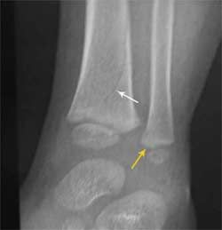 Nondisplaced Fracture of Tibia in a Child