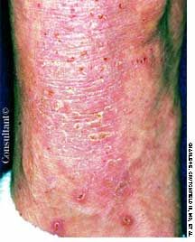 Lichen Simplex Chronicus