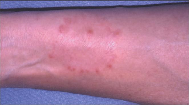 Differentiating the Types of Tinea | Patient Care
