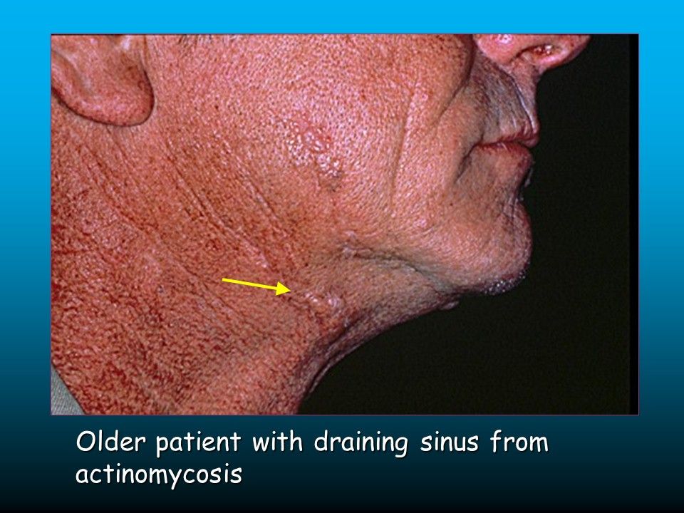 Lumpy Jaw In A 20 Year Old Male Resists Treatment Patient Care Online