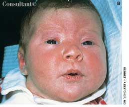 Dislocated Septal Cartilage