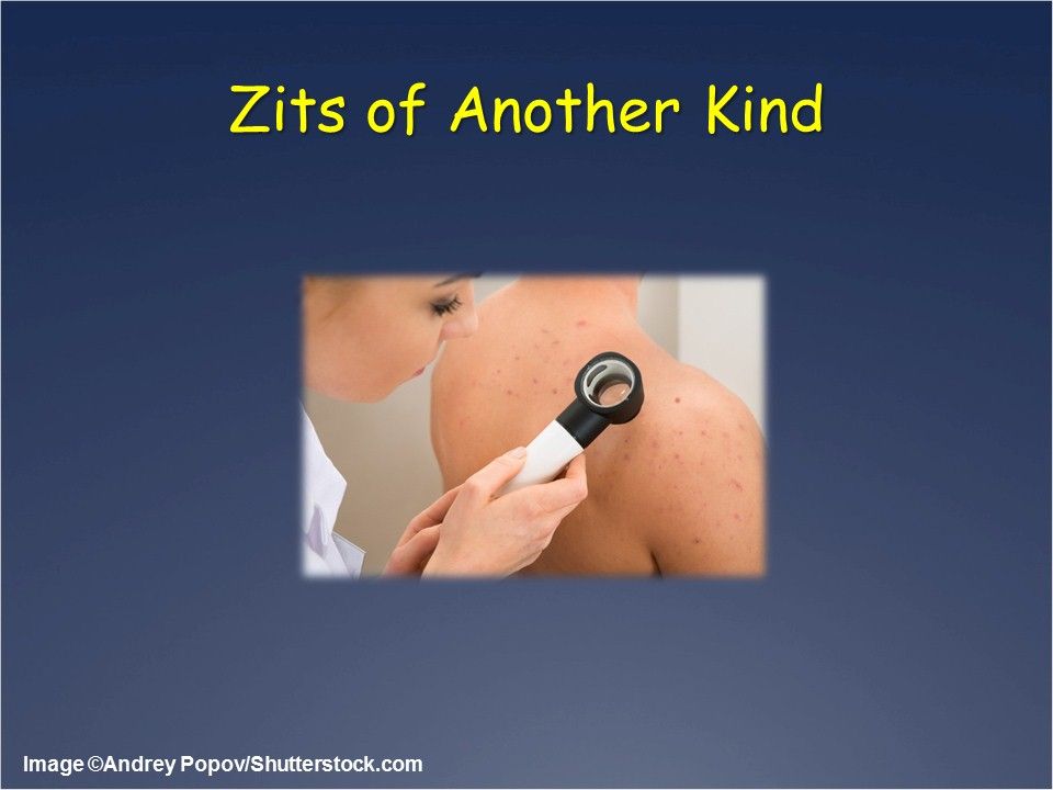 Zits of Another Kind