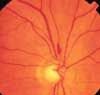 Optic Disc Hemorrhage Secondary to Glaucoma