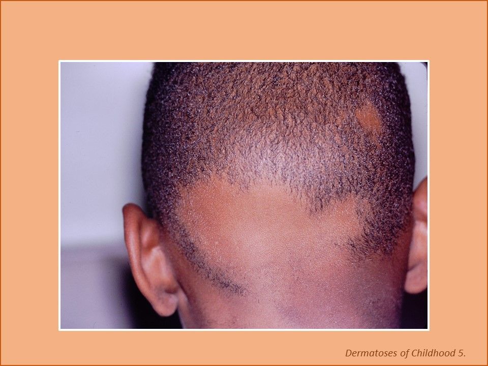 Dermatoses of Childhood: 7 Photoclinic Cases | Patient Care Online