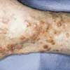 Erythema Elevatum Diutinum (EED)