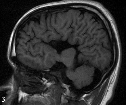 Talc Embolism: A Case of Extrapulmonary Complications
