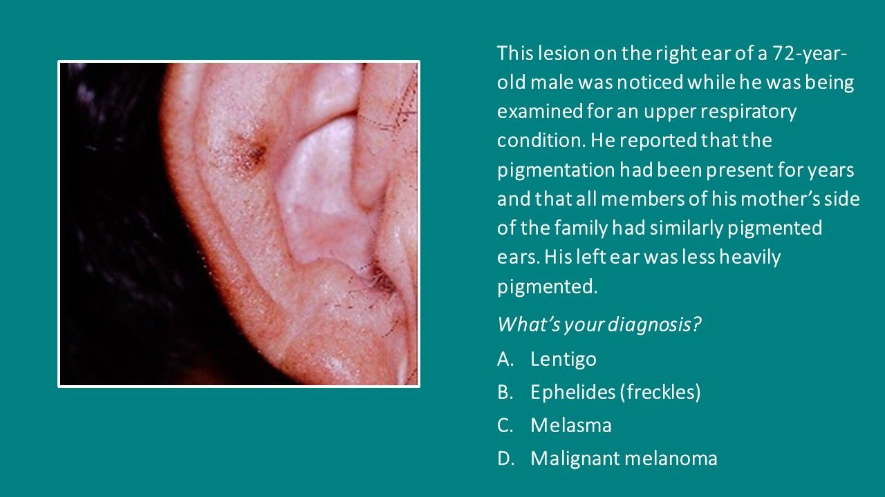 Lumps Bumps Calgary Ab Skin Lesion