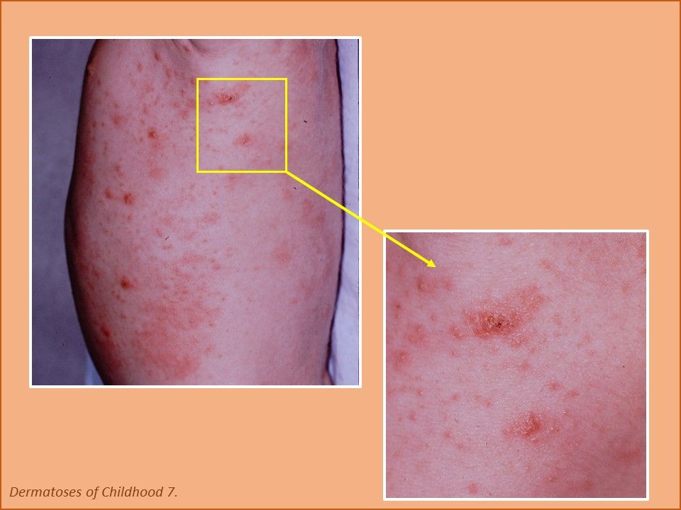 Dermatoses of Childhood: 7 Photoclinic Cases | Patient Care Online