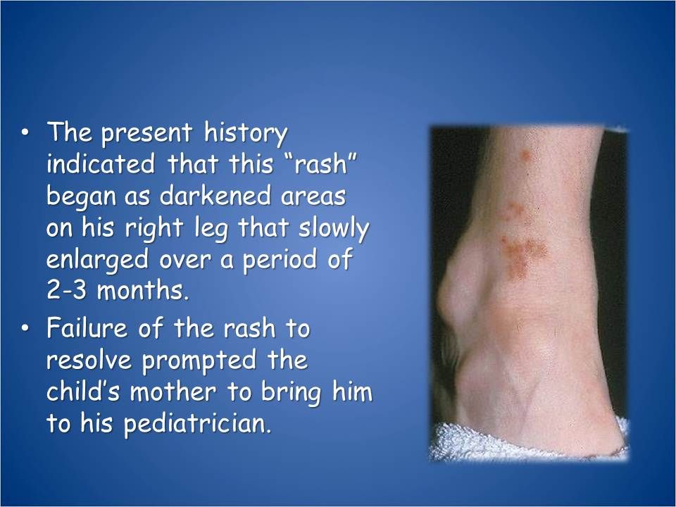 Puzzling Purpuras: Tale of an Unusual Bruise | Patient Care Online