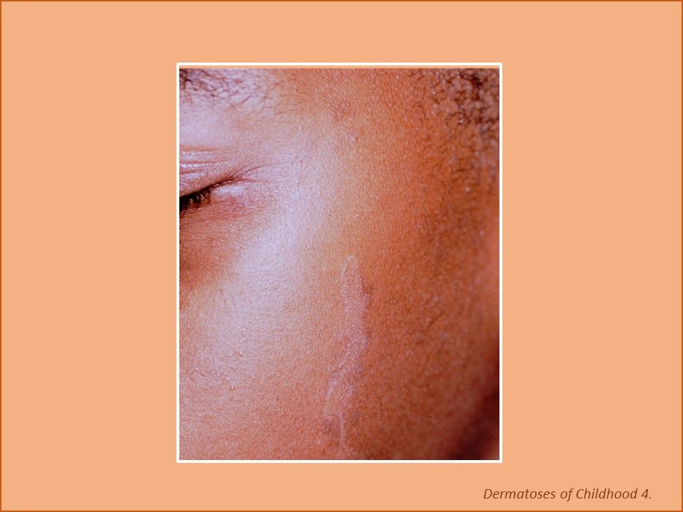 Dermatoses of Childhood: 7 Photoclinic Cases