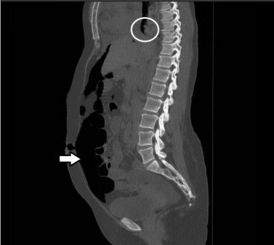 Pneumatosis Cystoides Intestinalis: What’s the Truth? | Patient Care Online