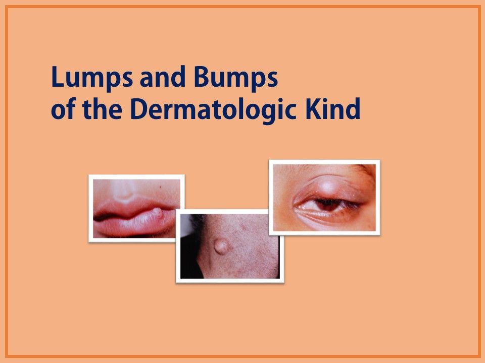 A Few Lumps and Bumps of the Dermatologic Kind