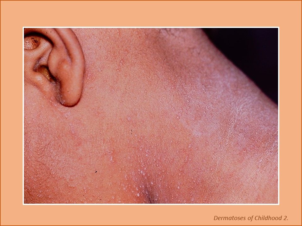 Dermatoses of Childhood: 7 Photoclinic Cases | Patient Care Online