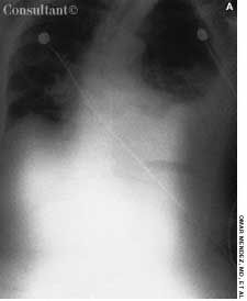 Boerhaave Syndrome | Patient Care Online