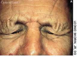 Benign Essential Blepharospasm Resulting in Blindness