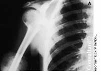 Humeral Surgical Neck Fracture