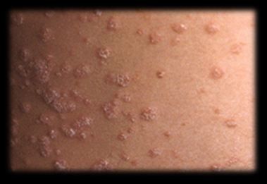 A Scaly Rash