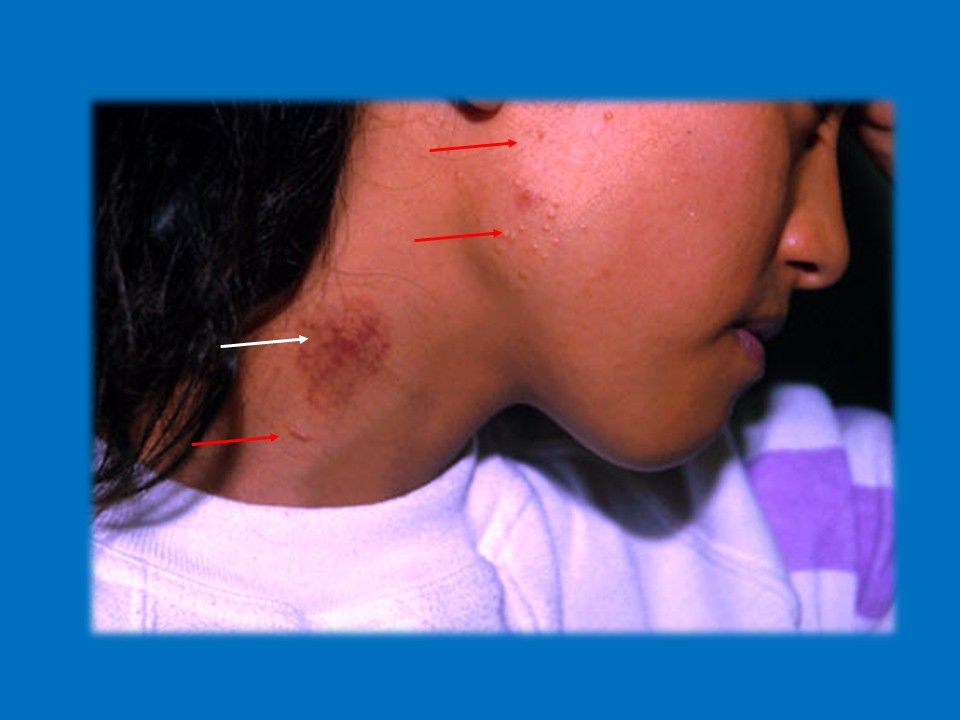 The HEEADSSS Psychosocial Inventory