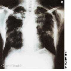 Subcutaneous Sarcoidosis