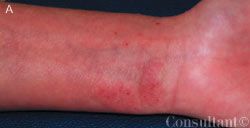 Allergic Contact Dermatitis from Hair Dye