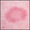 Why has this annular rash resisted antifungals?