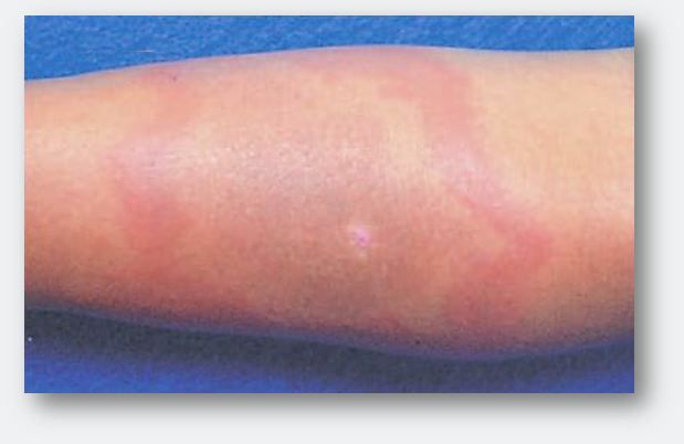 Quiz: 5 Skin Signs of Spring